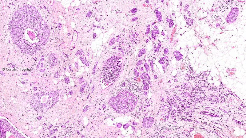 ᐅ Mastektomie bei Brustkrebs: Zwei ist besser als eine