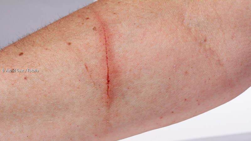 ᐅ Wenn sich Kinder selbst verletzen: Eltern sollten Überreaktionen ...