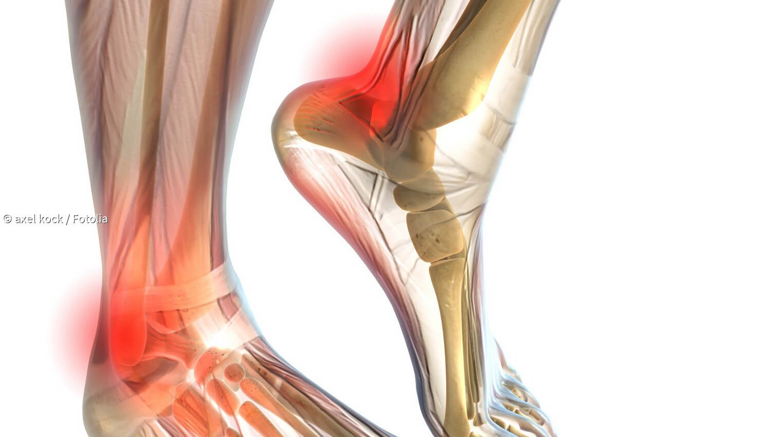 Kurzmeldungen zum Thema Bänderriss - paradisi.de